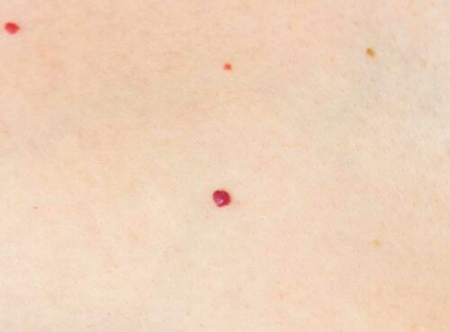 Cherry Angiomas / Red Spots Treatment | Laser Melbourne